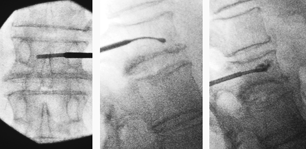 Putting Cement in a Broken Bone - HealthyCells Magazine