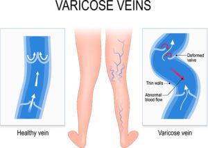 What Are Venous Valves, and Why Are They so Important? - HealthyCells ...