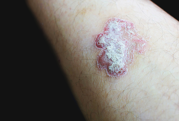 New Hope for Psoriasis - HealthyCells Magazine