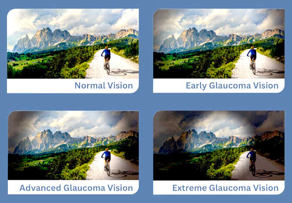 Shedding Light on Glaucoma - HealthyCells Magazine